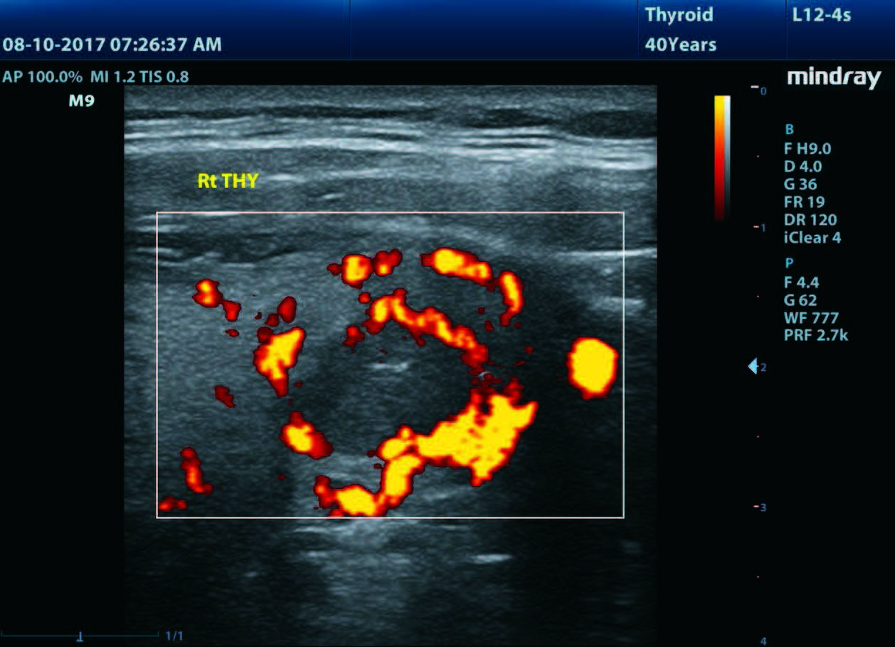 Icd 10 Code For Ling Nodules Icd 10 Code For Ling Nodules